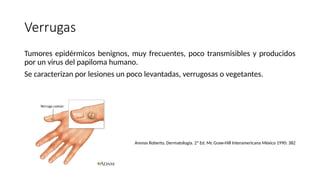 Verrugas y Molusco patologias dermatologicas | PPTX
