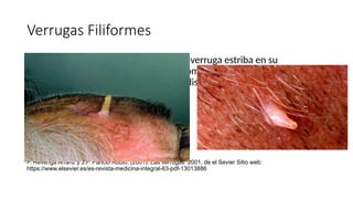 Verrugas y Molusco patologias dermatologicas | PPTX