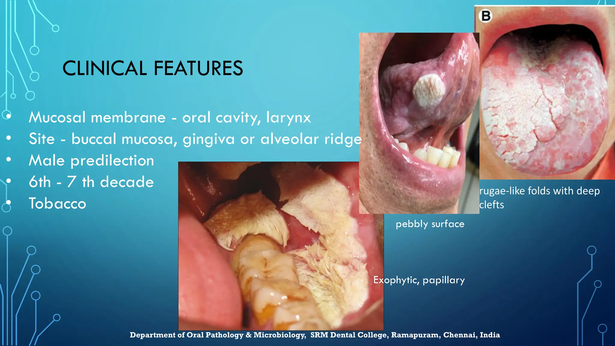 Verruocus Carcinoma - Clinical and histopathological features | PDF
