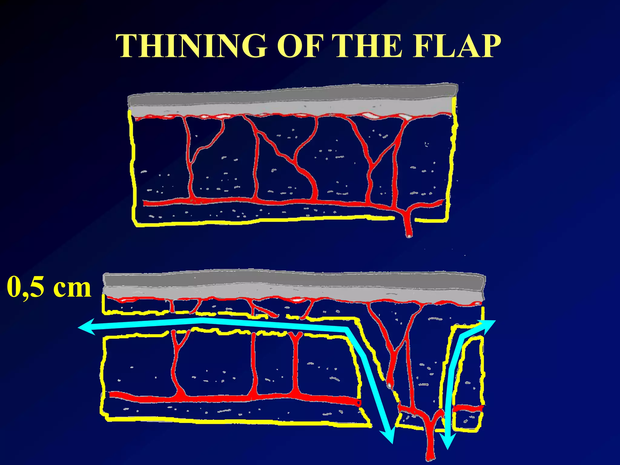 Versatility of anterolateral thigh free flap n. rajacic md | PDF