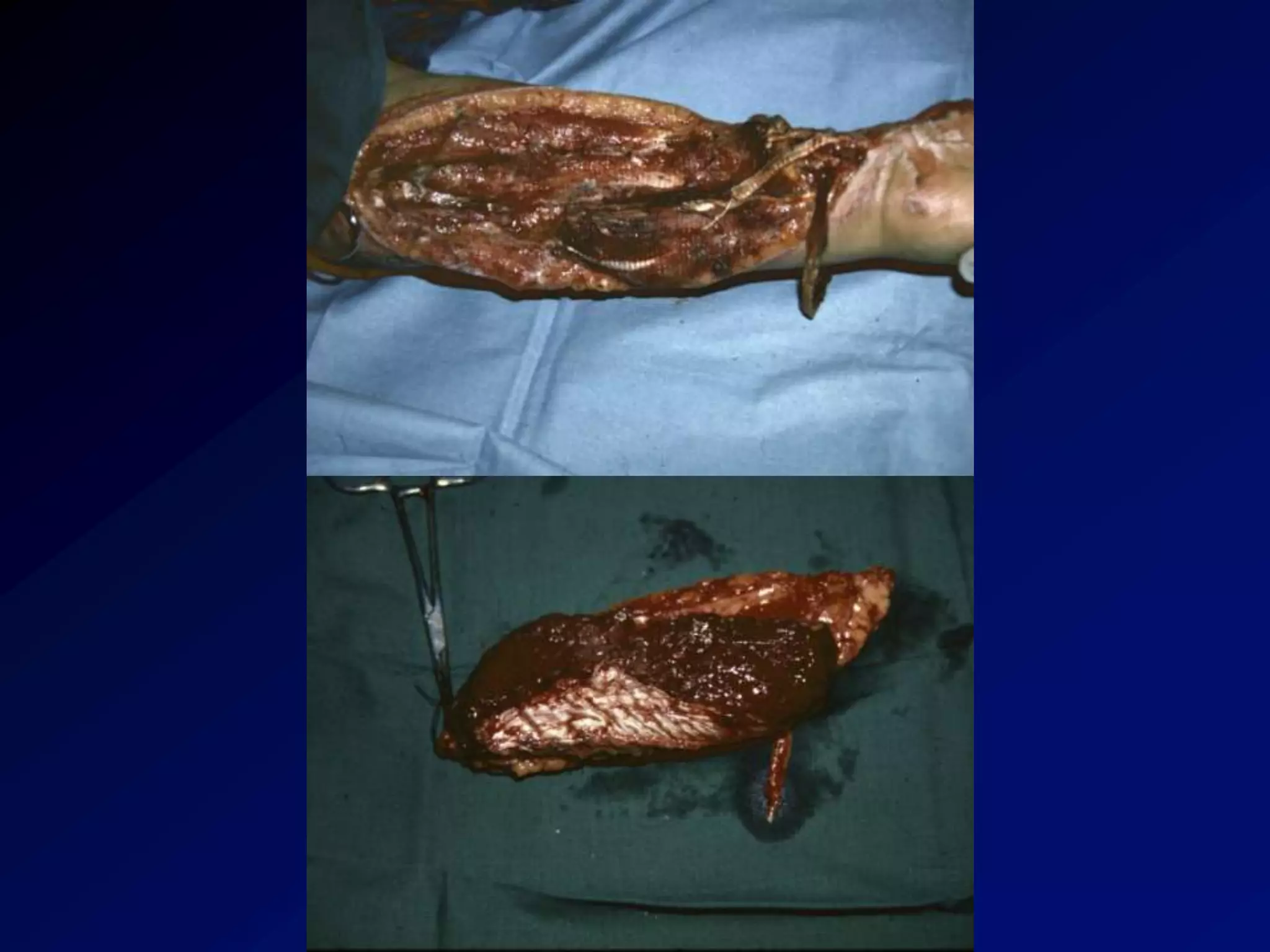 Versatility of anterolateral thigh free flap n. rajacic md | PDF