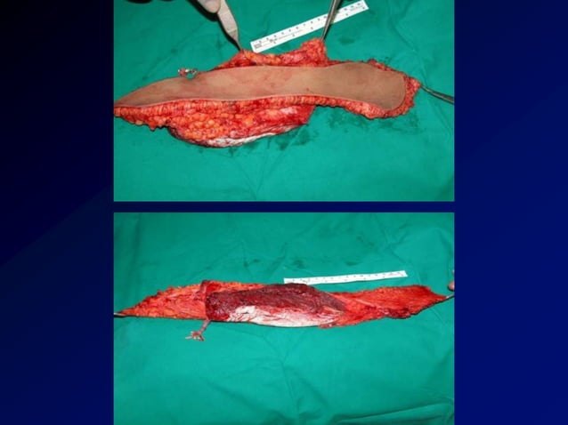 Versatility of anterolateral thigh free flap n. rajacic md | PDF ...