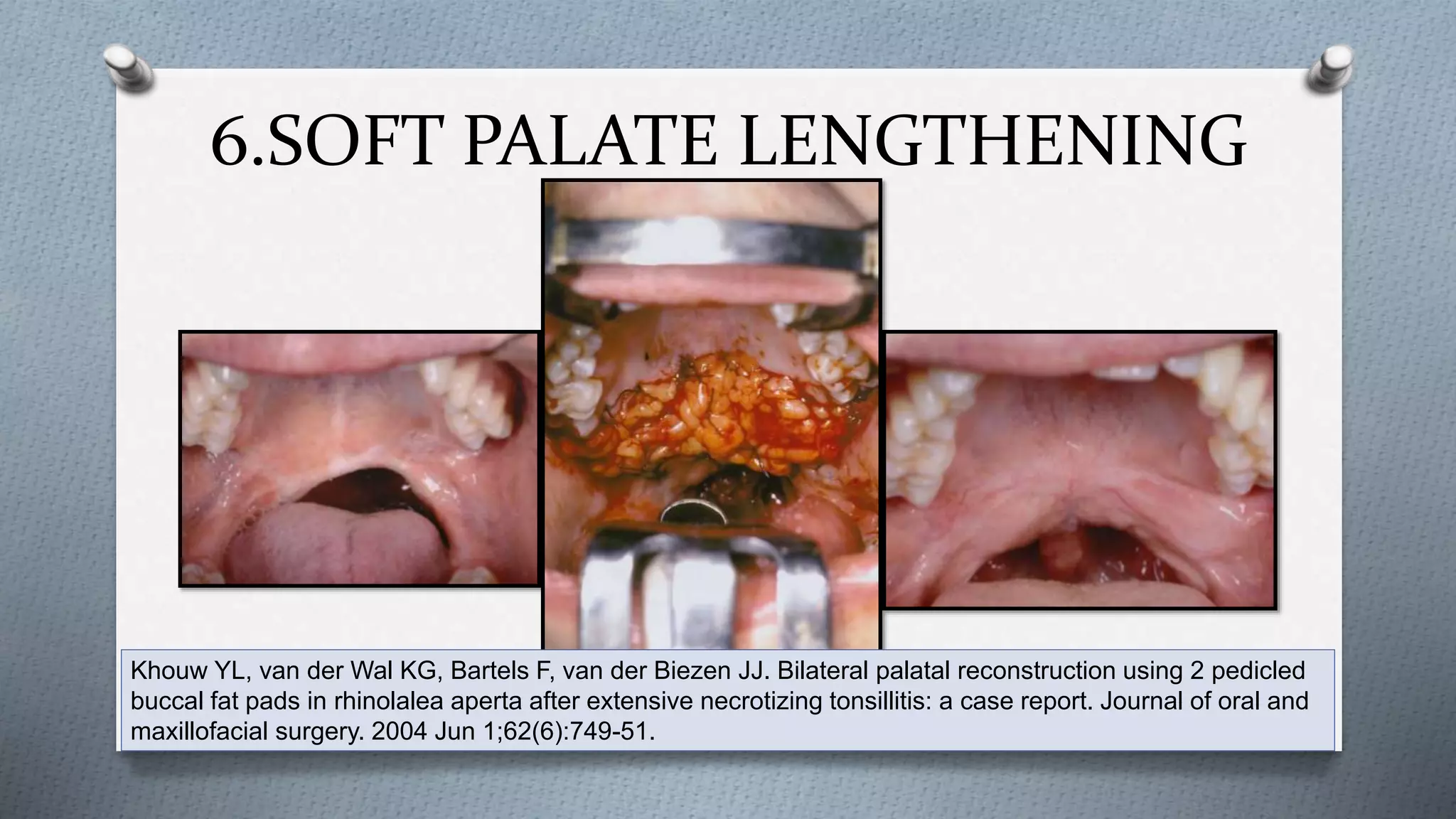 Versatility of buccal fat pad | PPTX