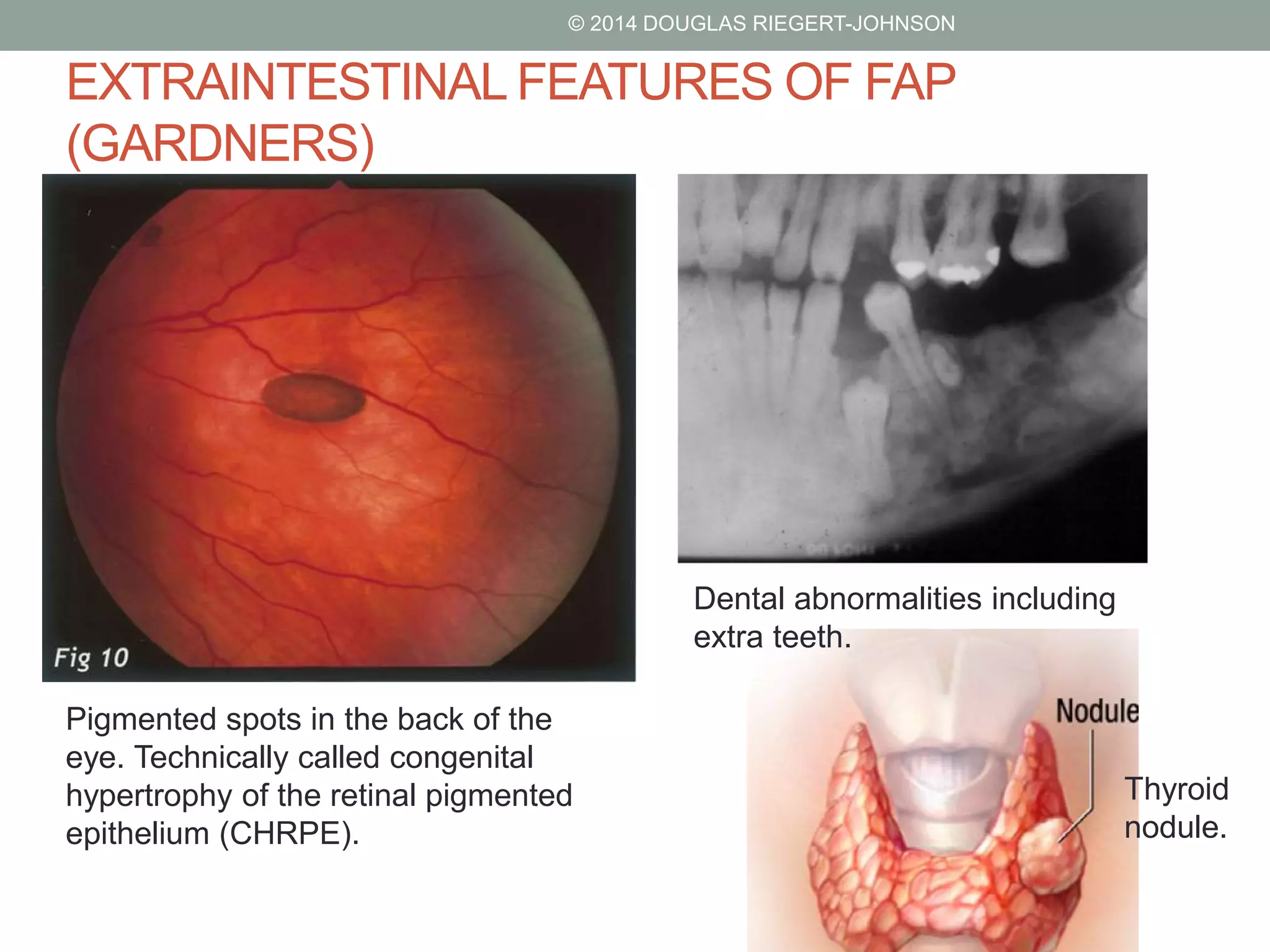 Companion slideshow for polyppolyp.com (Familial adenomatous polyposis ...