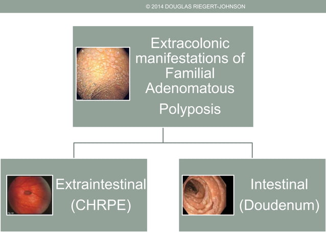 Companion slideshow for polyppolyp.com (Familial adenomatous polyposis ...
