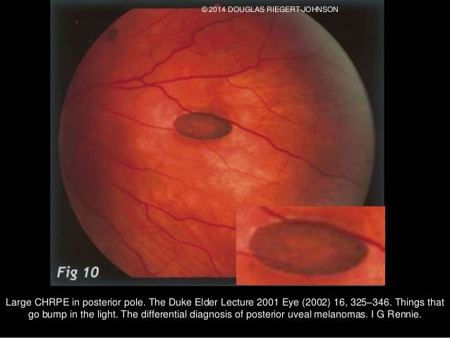 Companion slideshow for polyppolyp.com (Familial adenomatous polyposi…