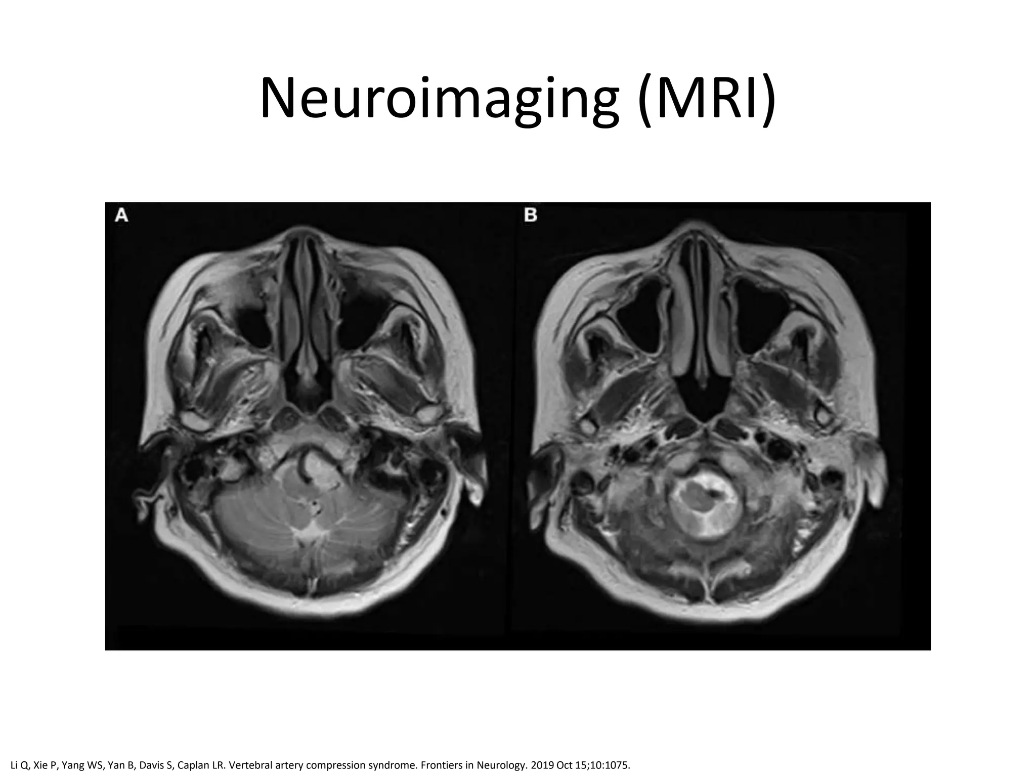 Vertebral Artery Compression Syndrome.pptx