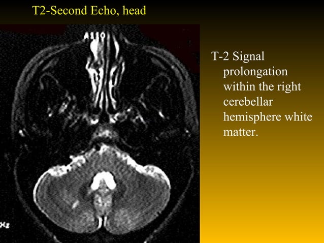 Vertebral artery dissection | PPT | Brain and Nervous System Disorders ...