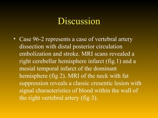 Vertebral artery dissection | PPT