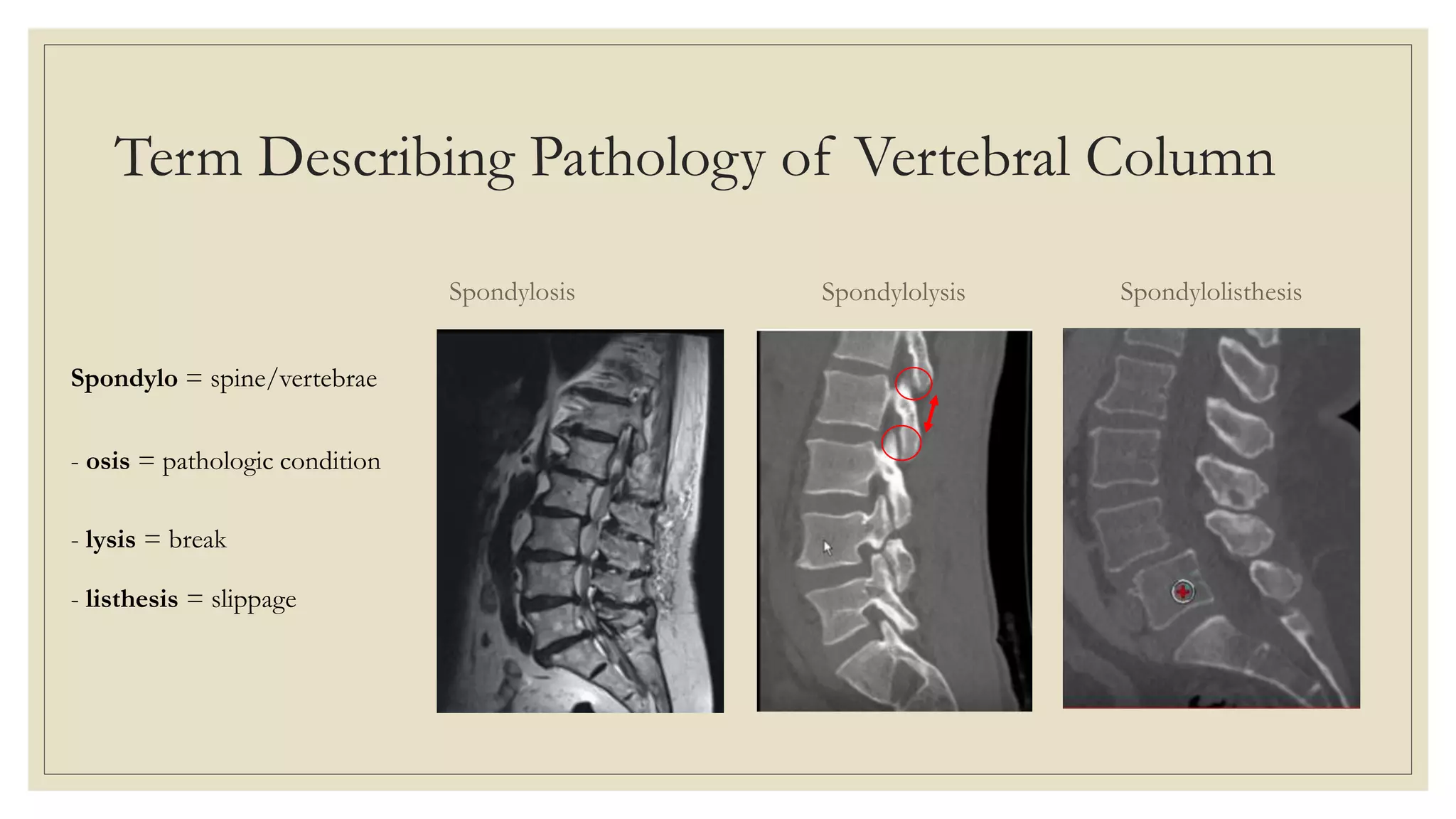 Vertebral column | PPTX