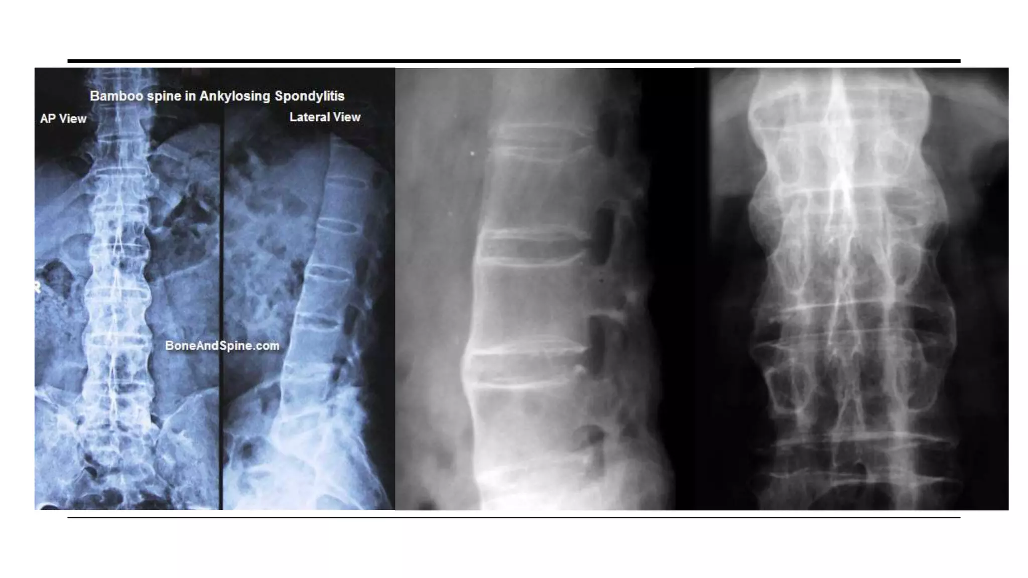 Vertebral column associated pathology and radiographic appearance | PPTX