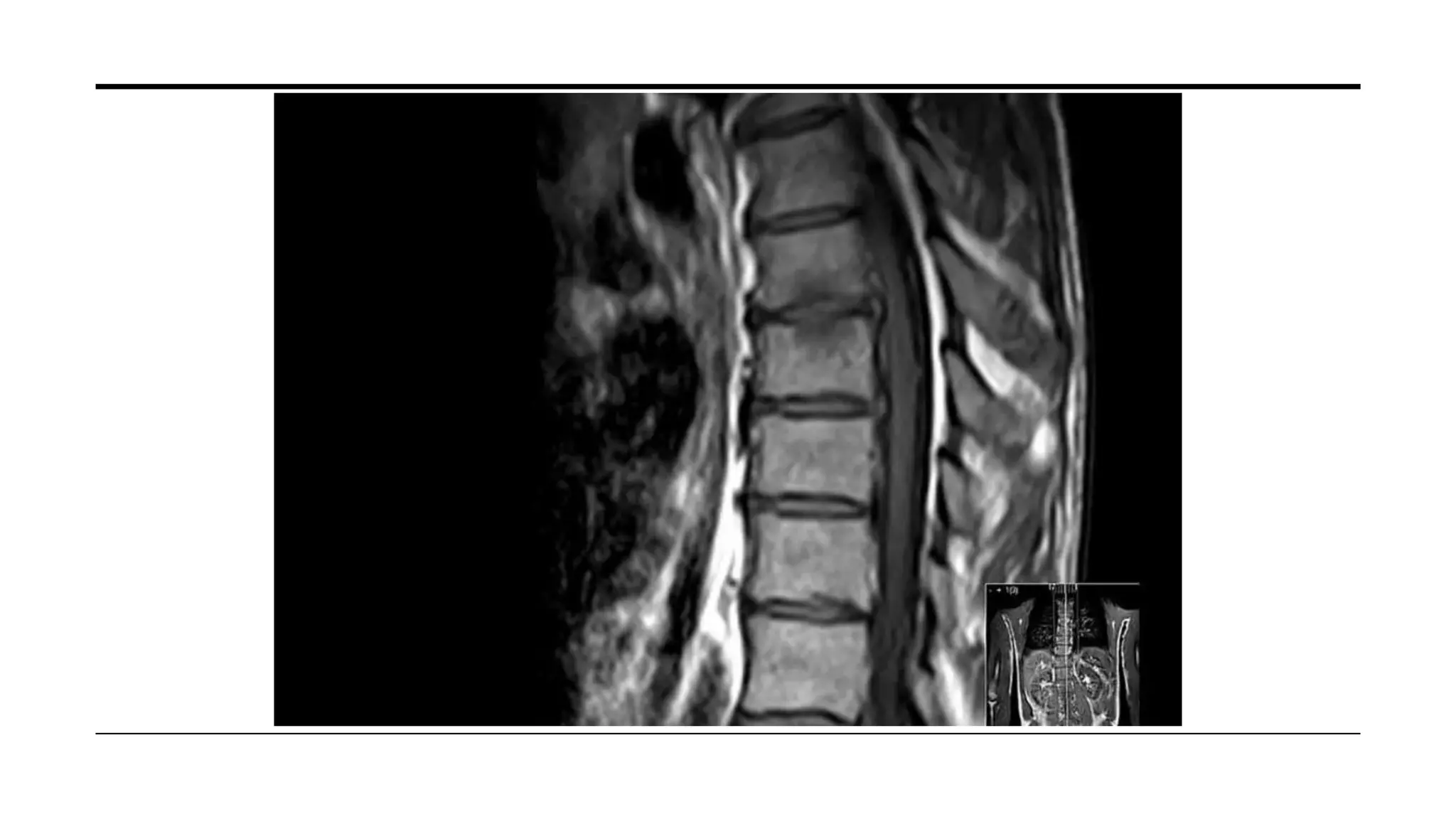 Vertebral column associated pathology and radiographic appearance | PPTX