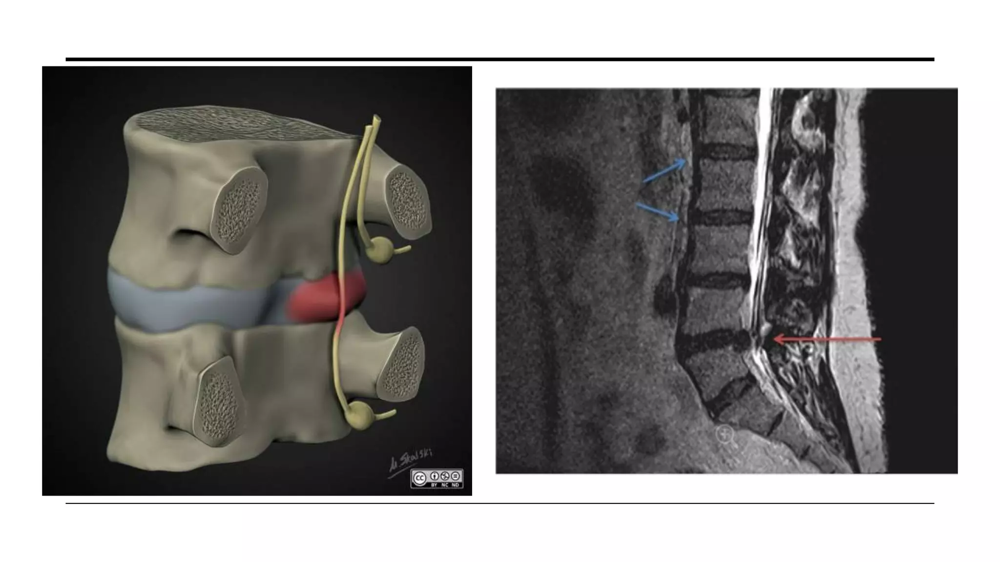 Vertebral column associated pathology and radiographic appearance | PPT