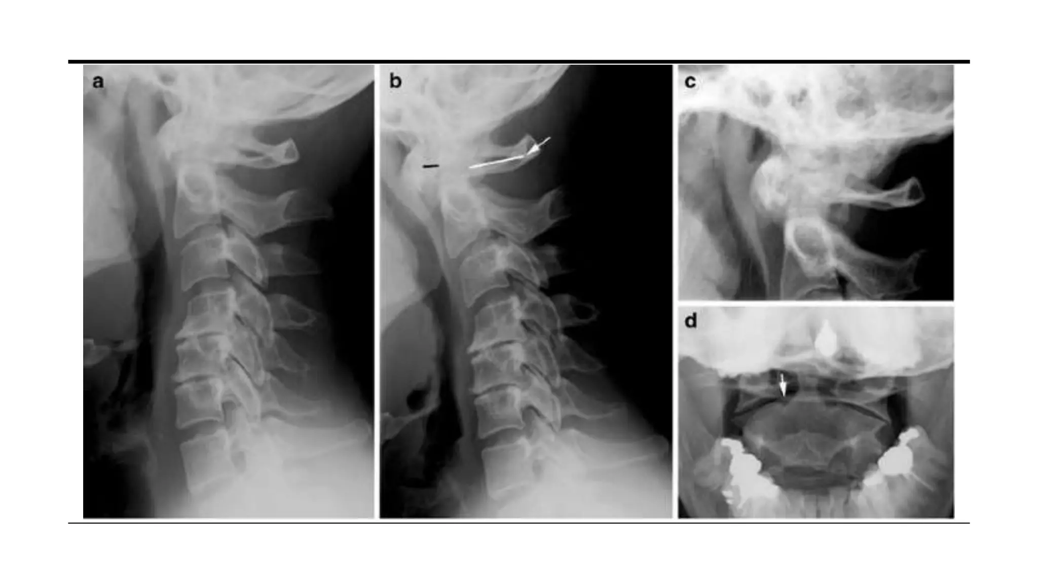 Vertebral column associated pathology and radiographic appearance | PPTX