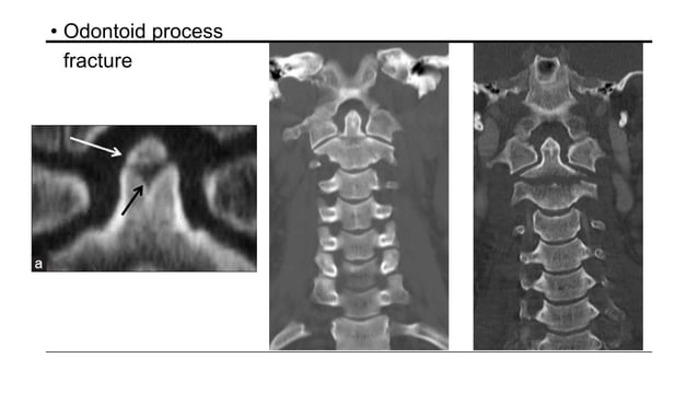 Vertebral column associated pathology and radiographic appearance | PPT