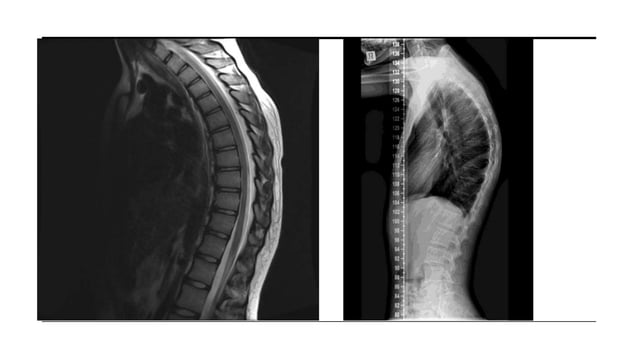 Vertebral column associated pathology and radiographic appearance | PPT