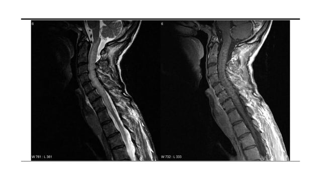 Vertebral column associated pathology and radiographic appearance | PPT
