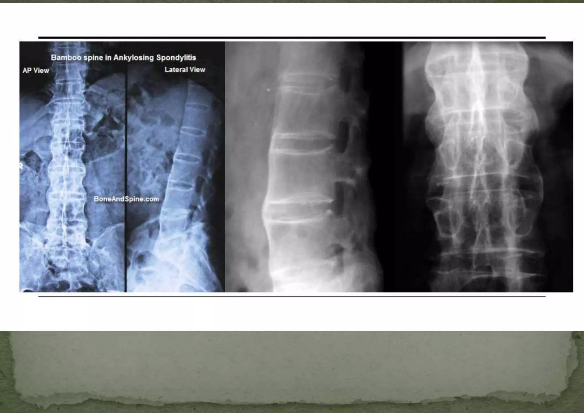 Vertebral column pathology , PPT, | PPTX