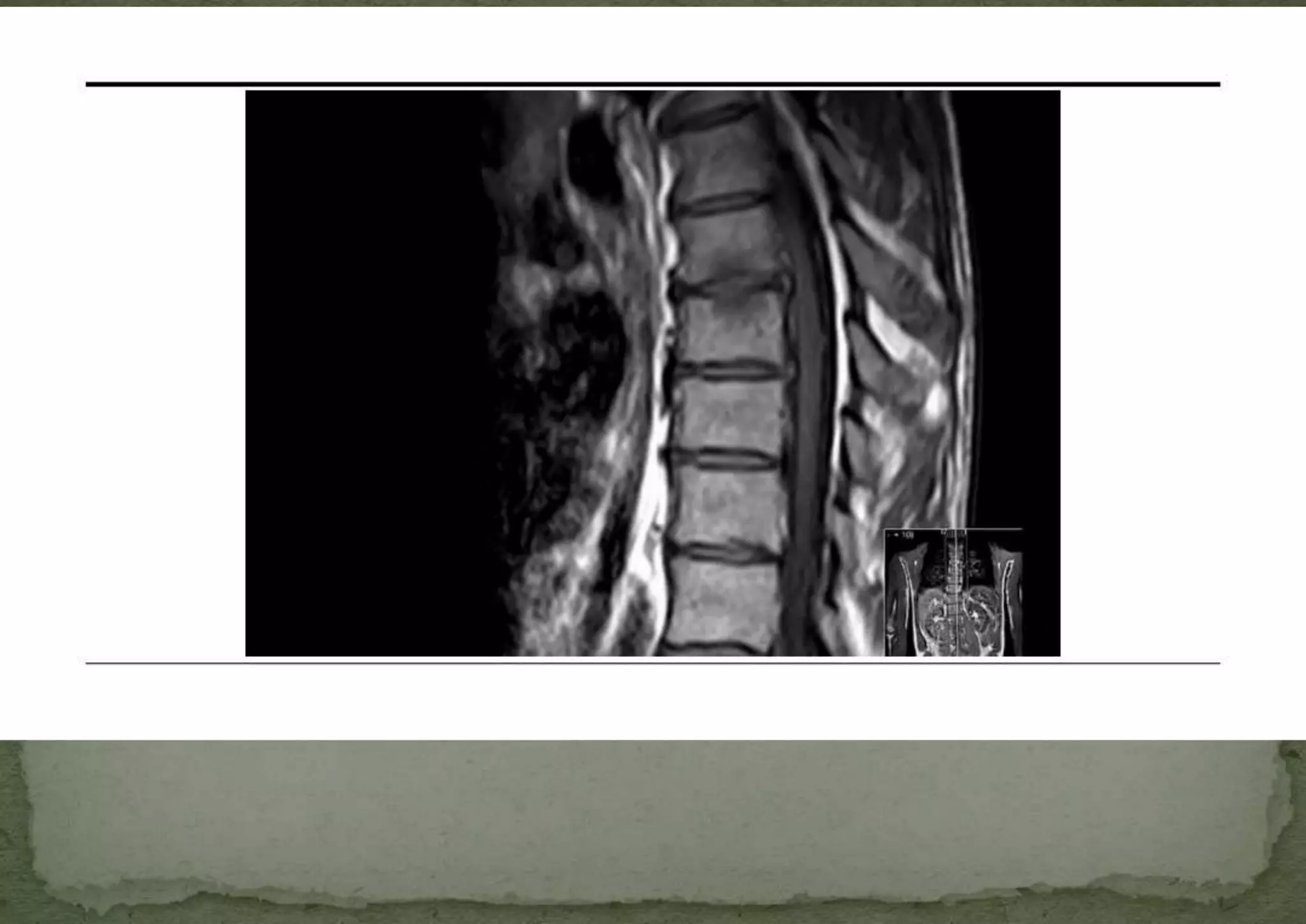 Vertebral column pathology , PPT, | PPTX
