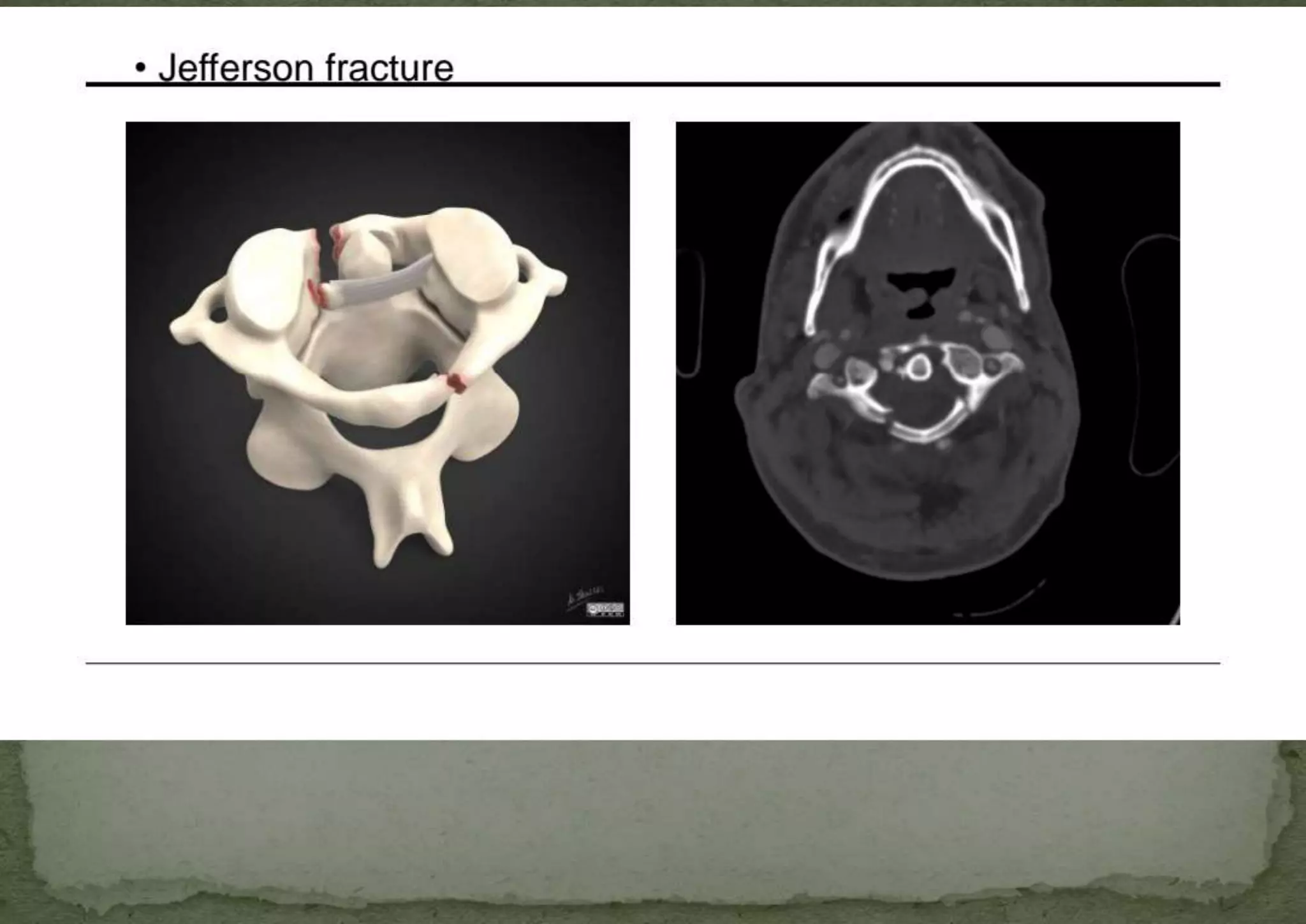 Vertebral column pathology , PPT, | PPTX