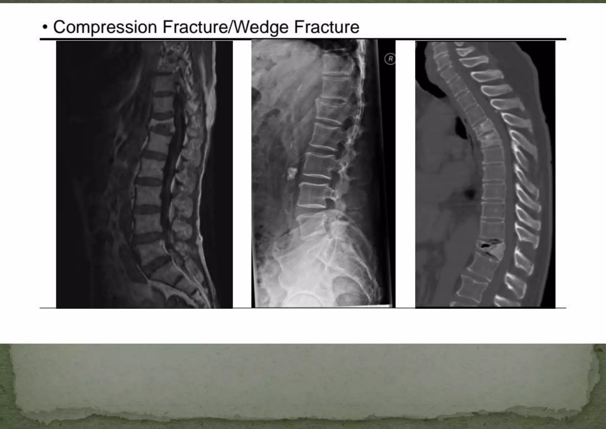 Vertebral column pathology , PPT, | PPTX