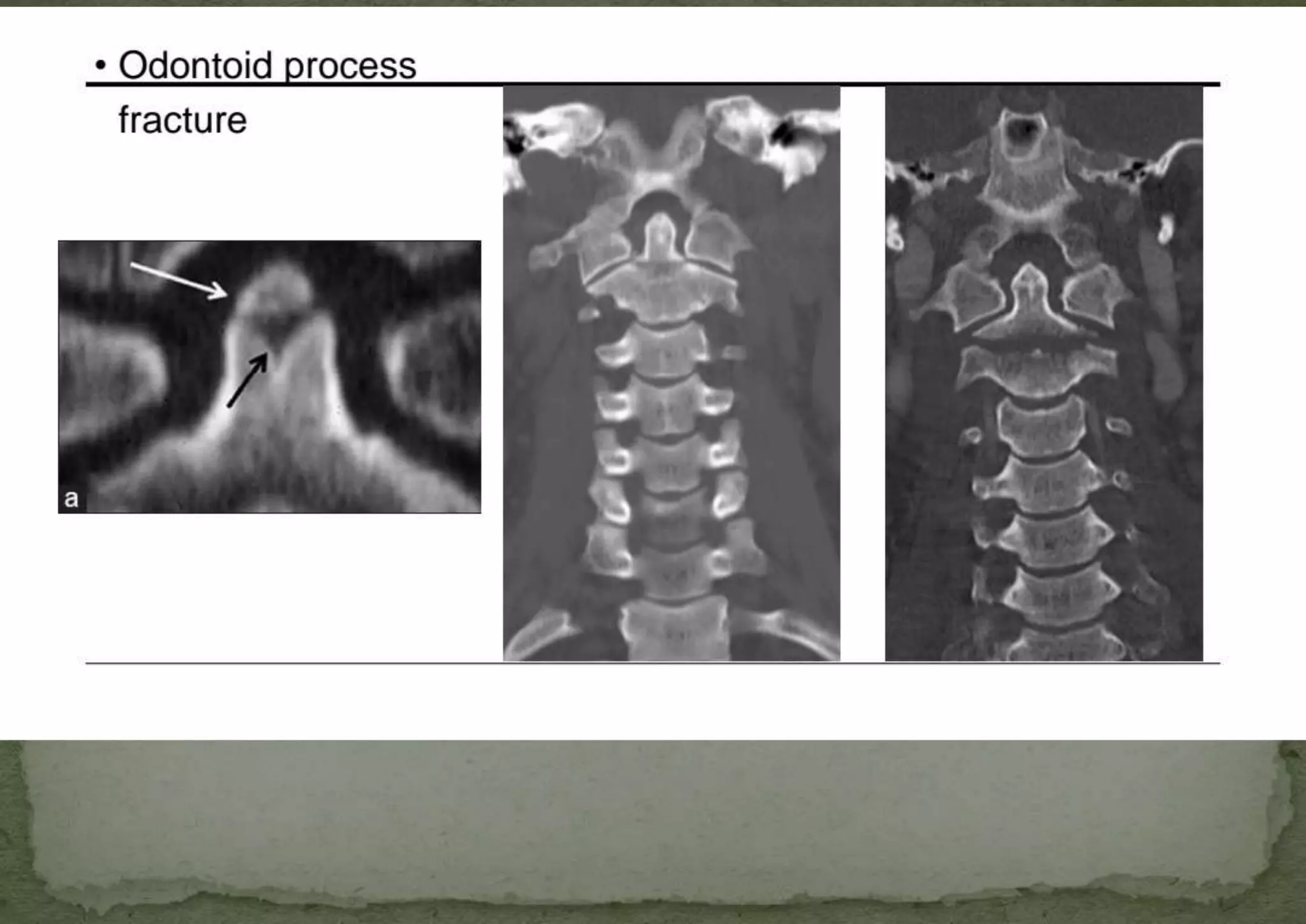Vertebral column pathology , PPT, | PPTX