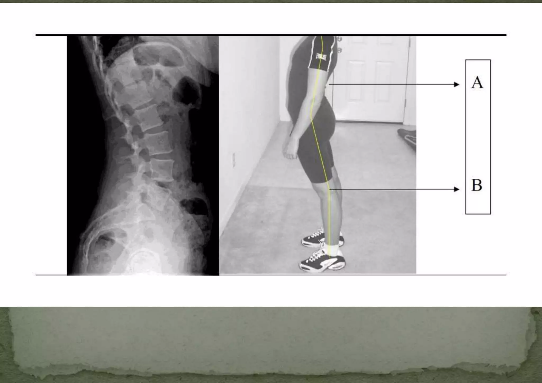 Vertebral column pathology , PPT, | PPTX