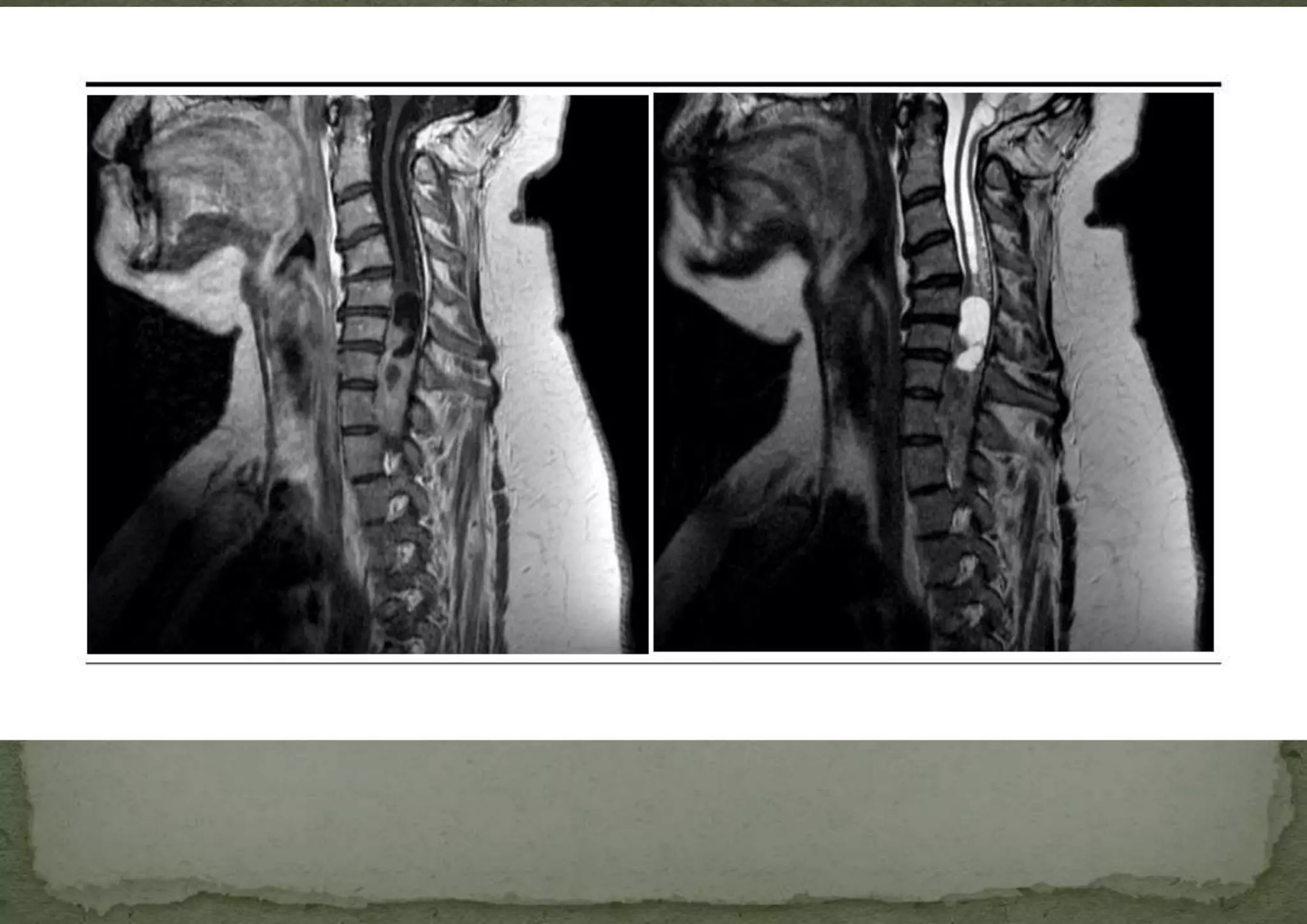 Vertebral column pathology , PPT, | PPTX