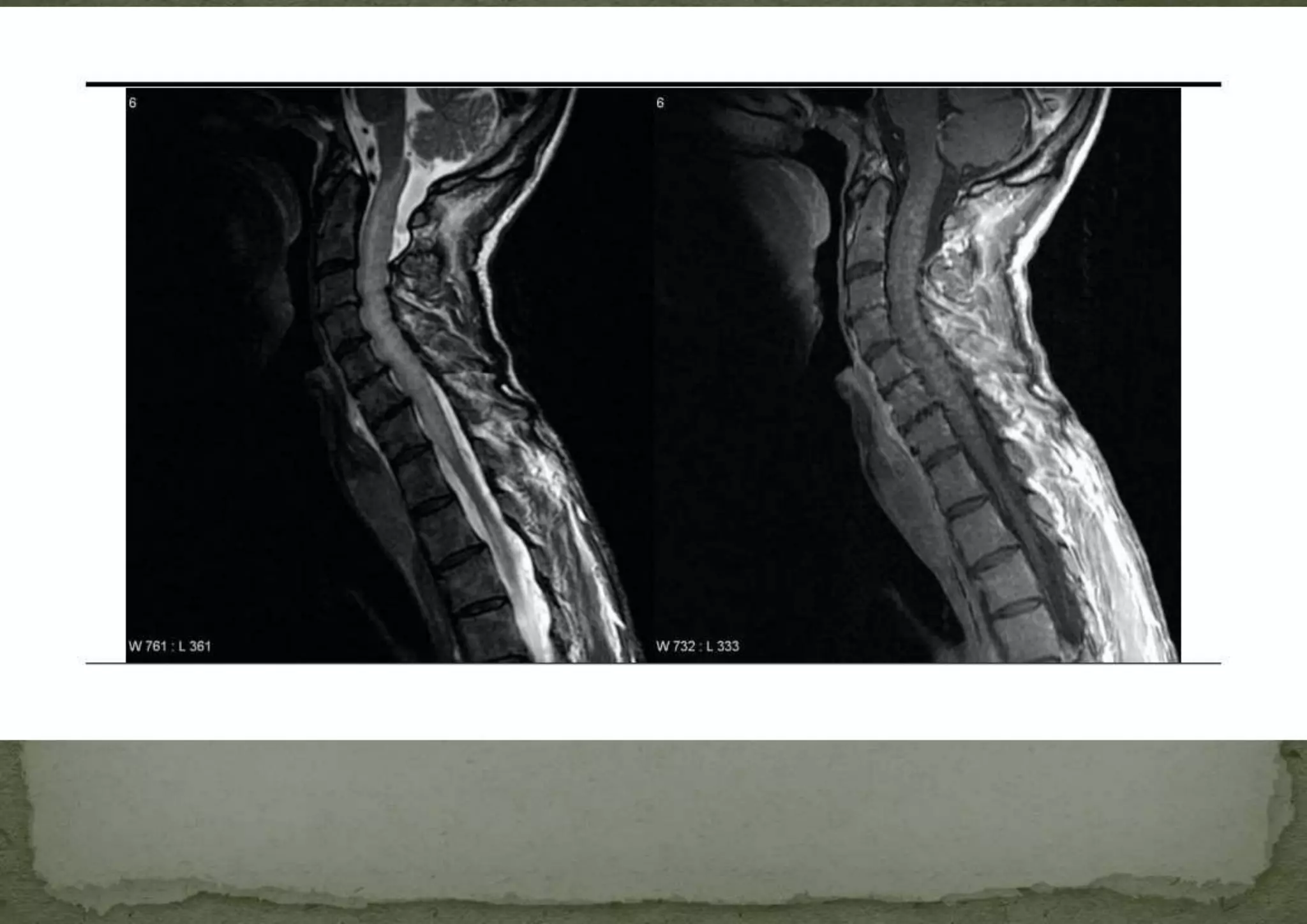 Vertebral column pathology , PPT, | PPTX