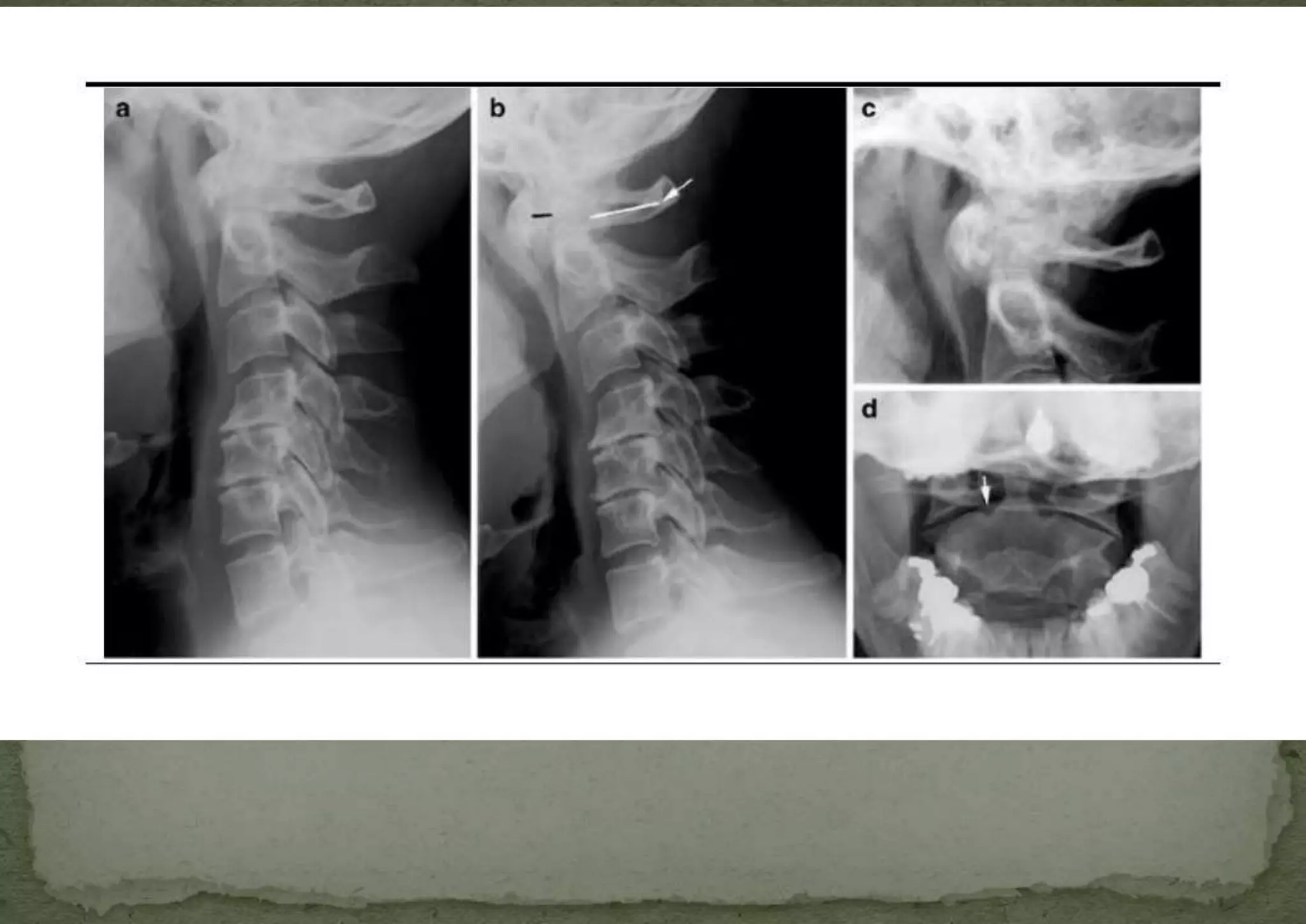 Vertebral column pathology , PPT, | PPTX