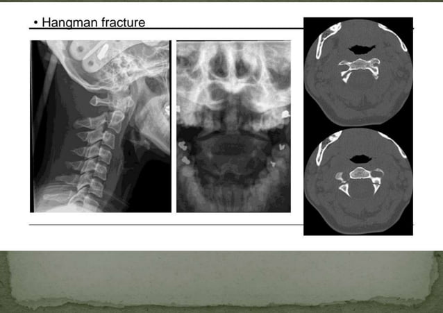 Vertebral column pathology , PPT, | PPTX