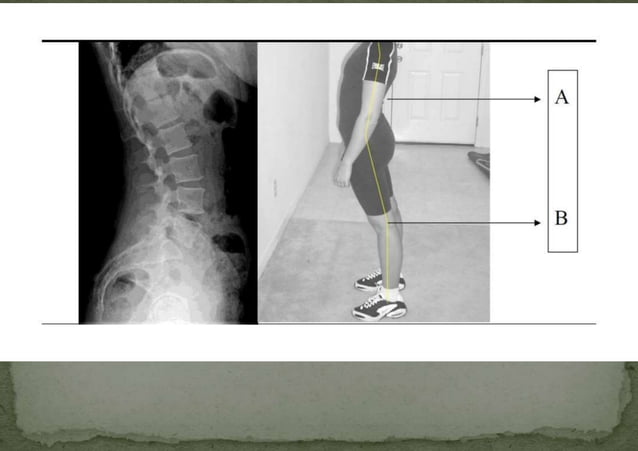 Vertebral column pathology , PPT, | PPTX