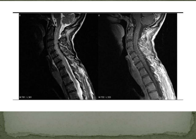 Vertebral column pathology , PPT, | PPTX