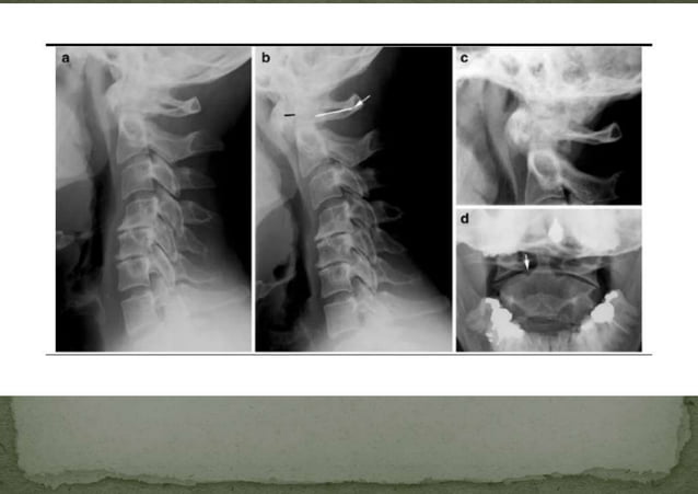 Vertebral column pathology , PPT, | PPTX