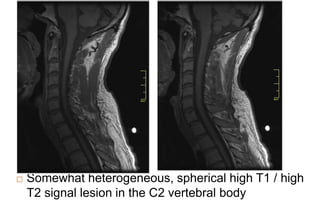 Vertebral hemangiomas.pptx