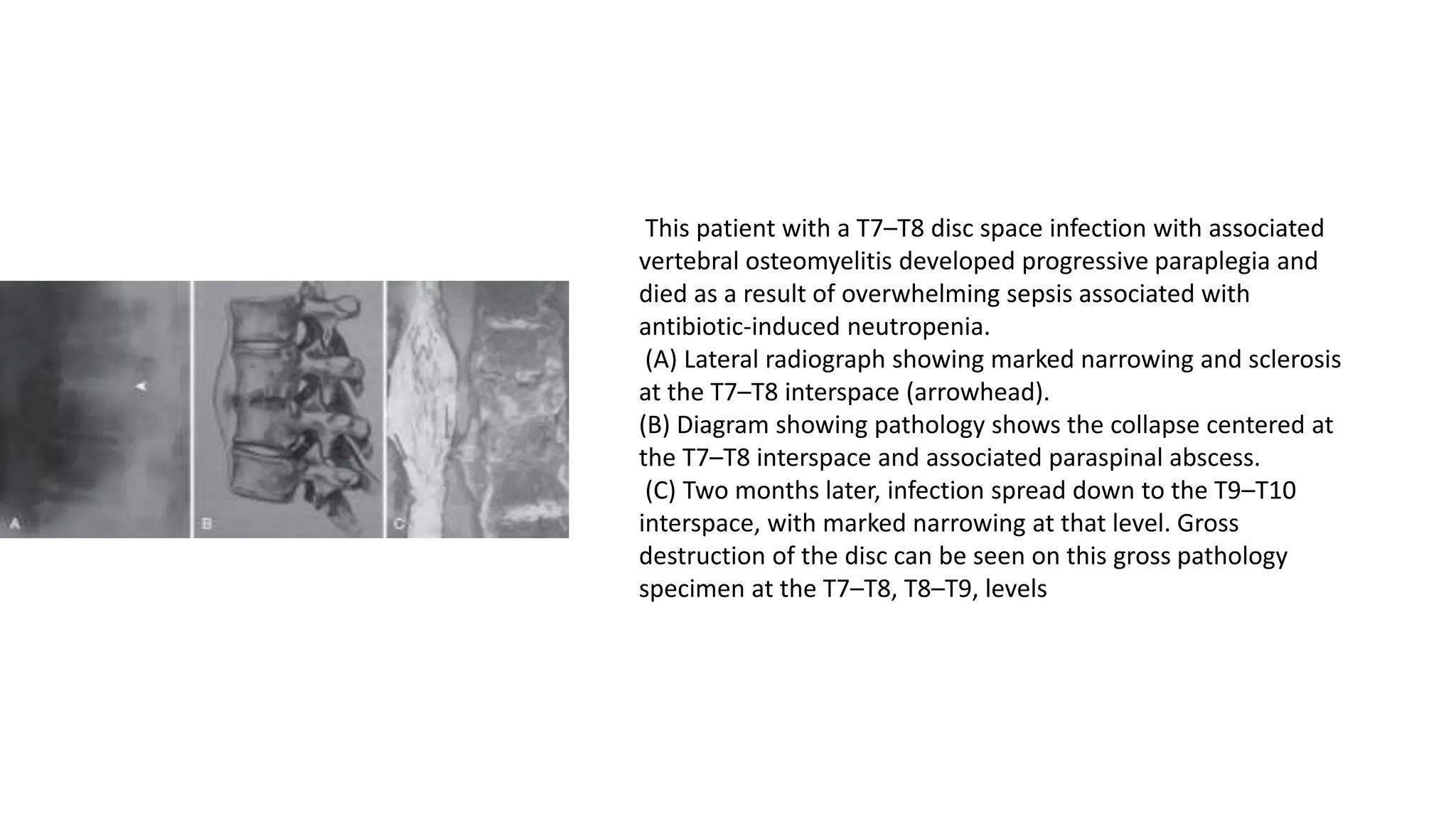 VERTEBRAL OSTEOMYELITIS.pptx