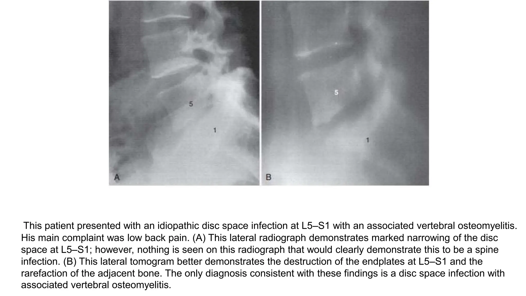 VERTEBRAL OSTEOMYELITIS.pptx