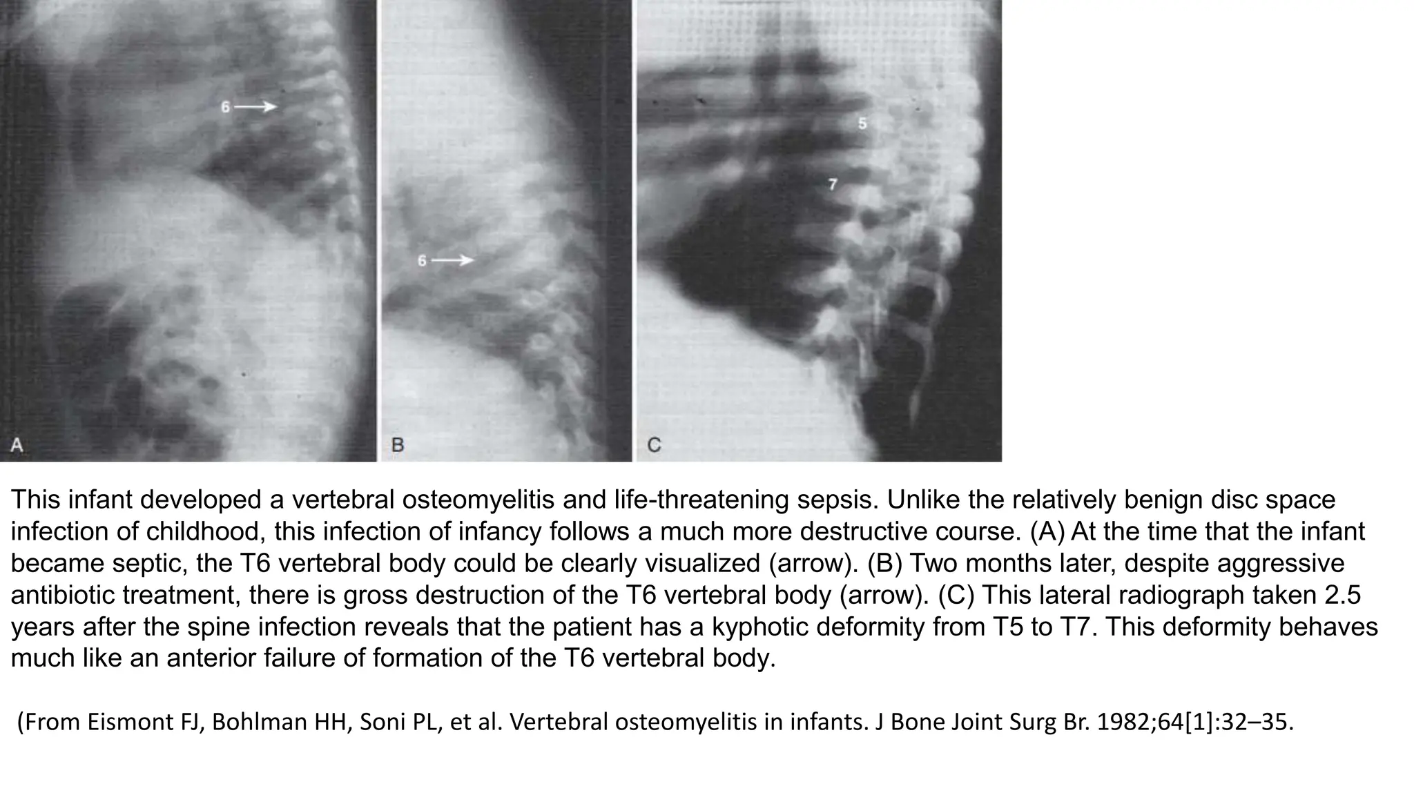VERTEBRAL OSTEOMYELITIS.pptx