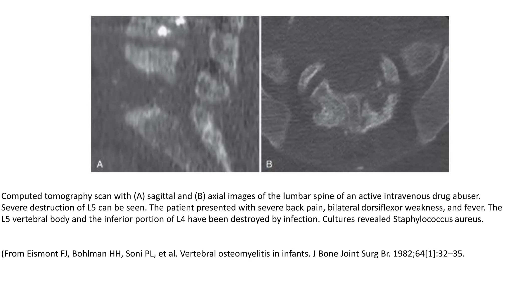 VERTEBRAL OSTEOMYELITIS.pptx
