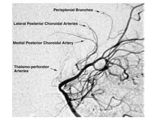 Posterior Choroidal Artery