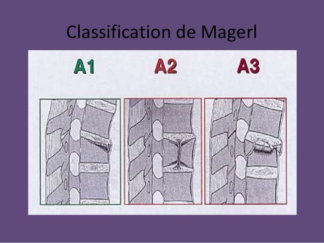 Vertebroplastie et tassements porotiques