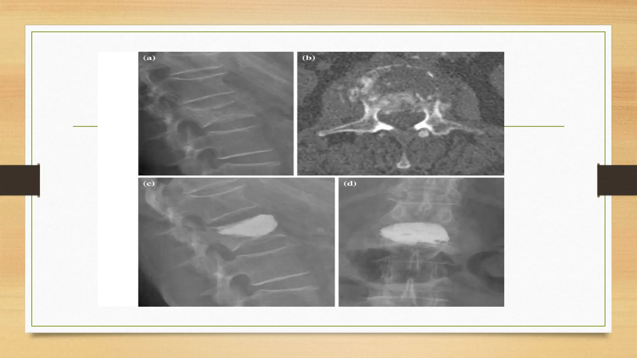 Vertebroplasty1 best presentation ortho.pptx