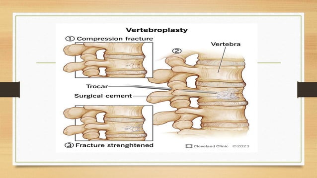 Vertebroplasty1 best presentation ortho.pptx