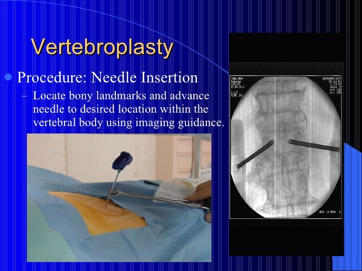 Vertebroplasty Grand Rounds