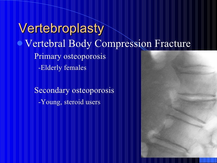 Vertebroplasty Grand Rounds