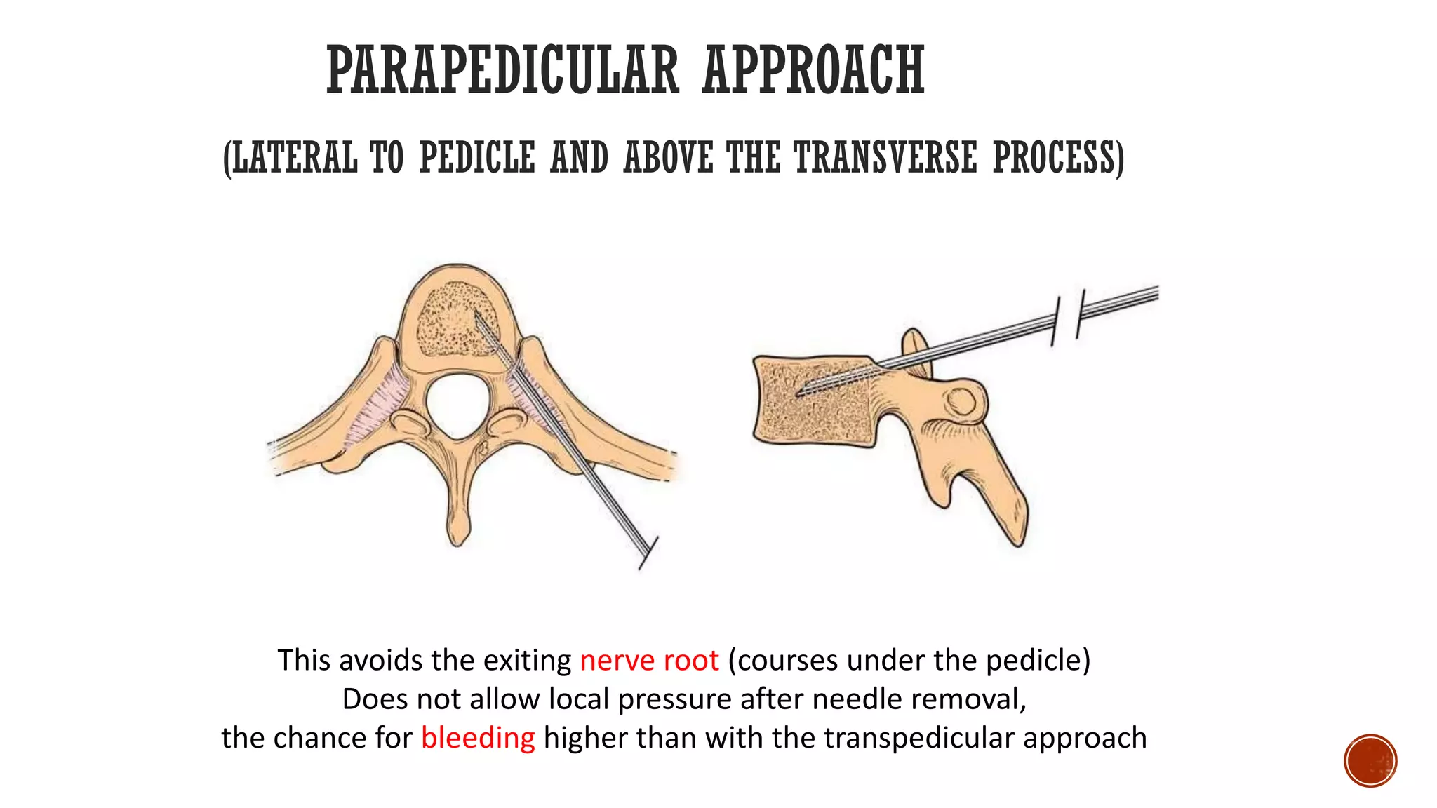 Vertebroplasty and Kyphoplasty | PDF