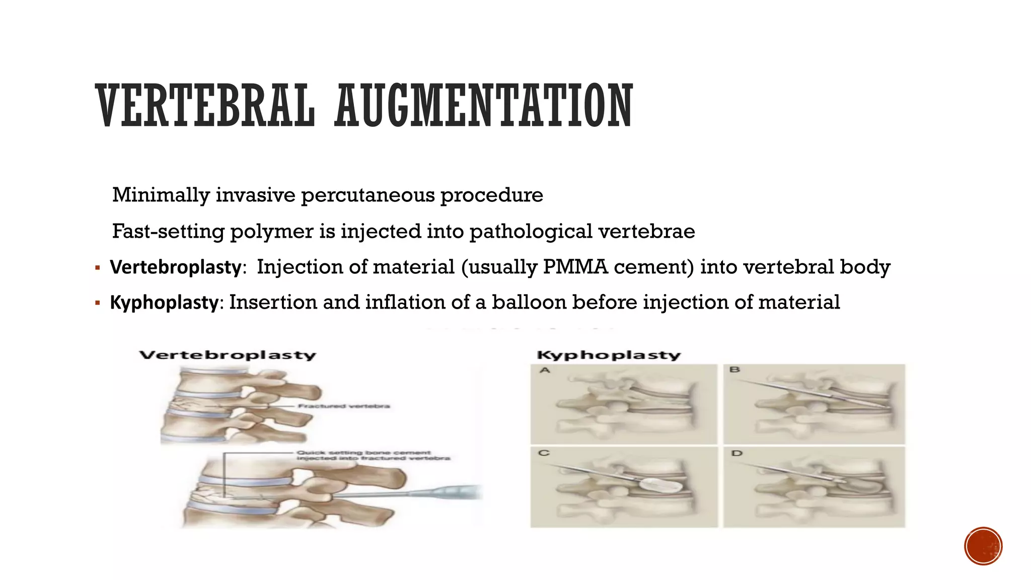 Vertebroplasty and Kyphoplasty | PDF