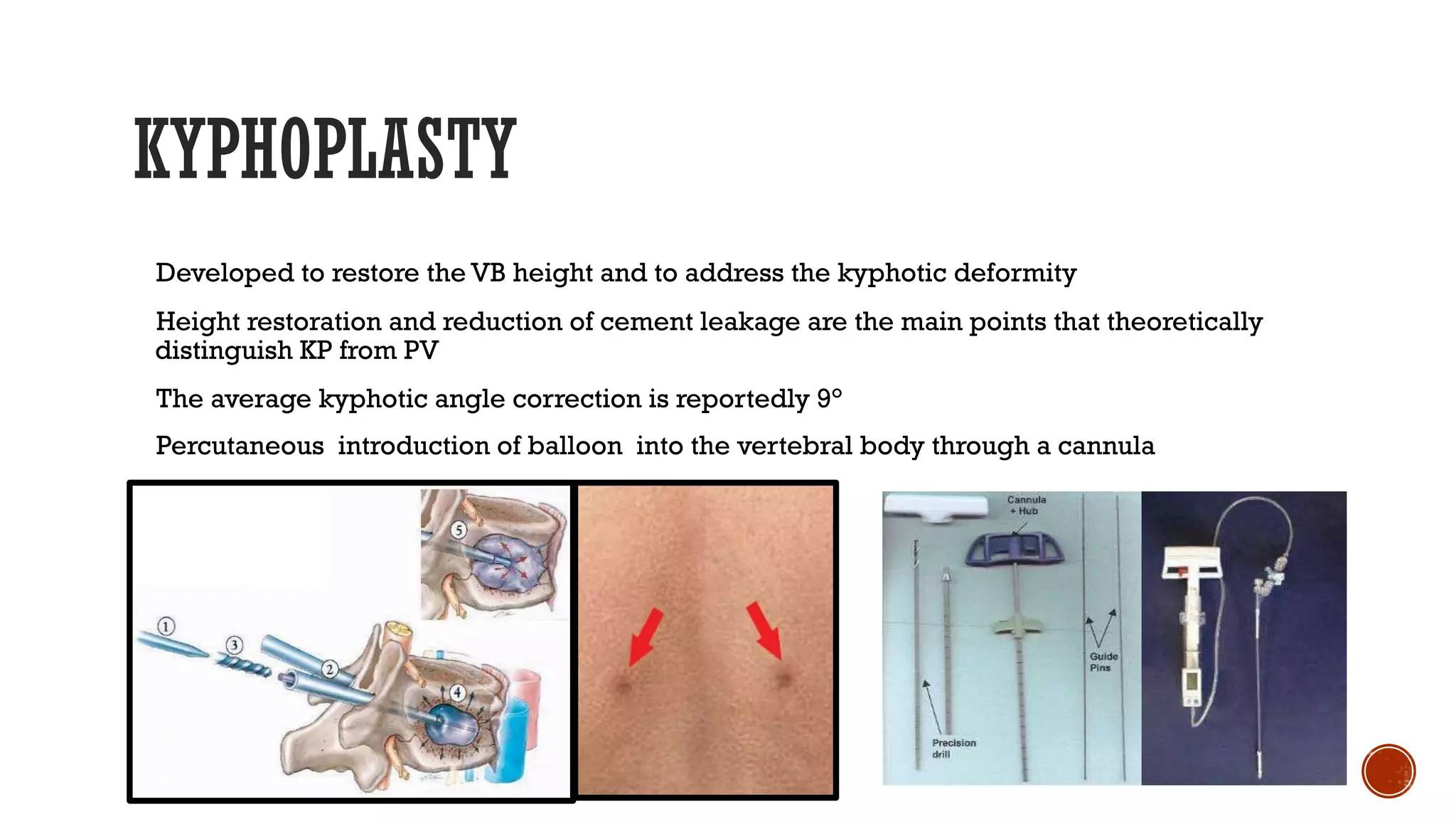 Vertebroplasty and Kyphoplasty | PDF