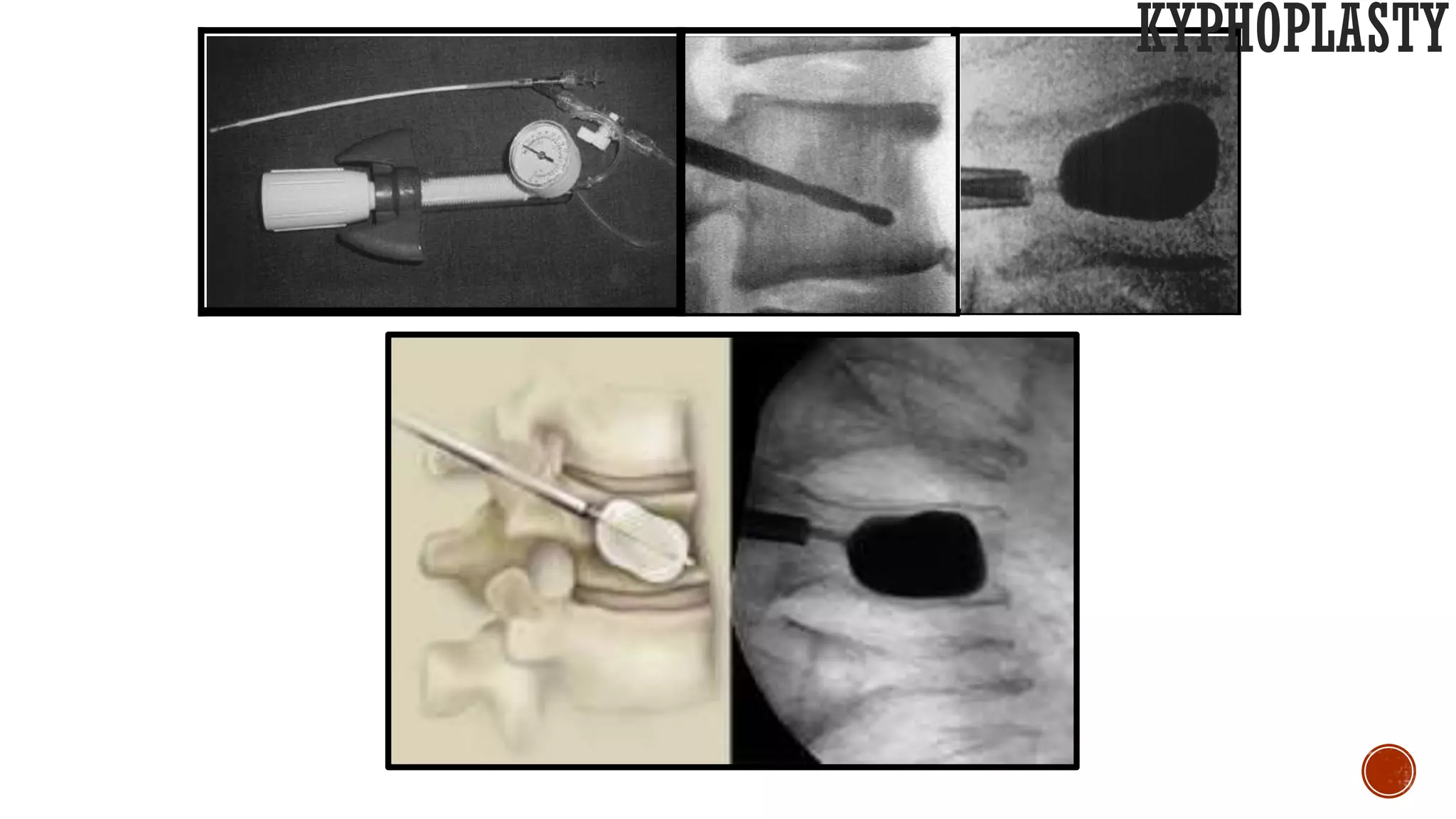 Vertebroplasty and Kyphoplasty | PDF