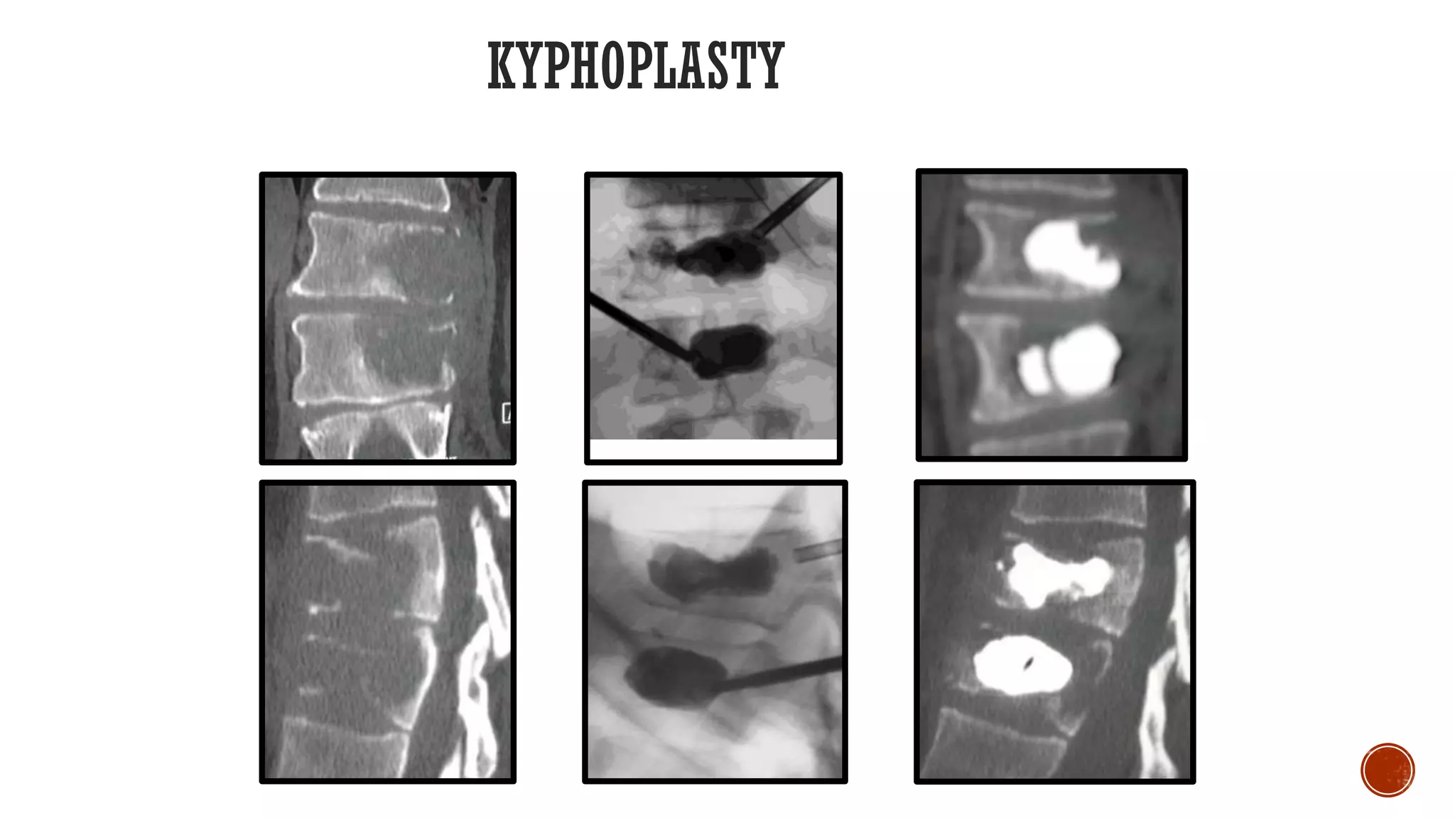 Vertebroplasty and Kyphoplasty | PDF